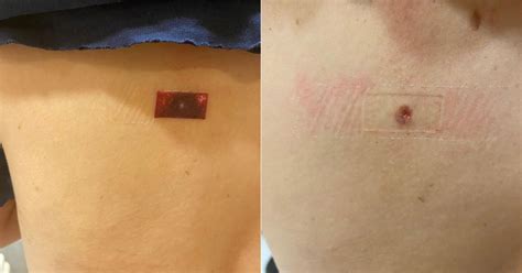 Spore Woman Gets Half A Mole On Her Back Ripped Off During Spa Massage