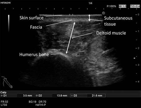 Nursing Intramuscular Injection Sites Youtube Kkm74 Gluteus Maximus