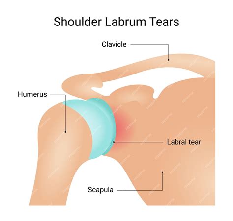 Premium Vector Symptoms Of Shoulder Labrum Tear