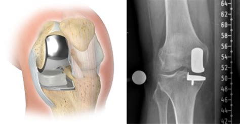 Partial Knee Replacement Chattanooga Center For Joint Replacement And Orthopedics