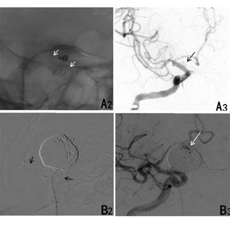 A A Ruptured Blood Blister Aneurysm Treated With A Ped A1 A