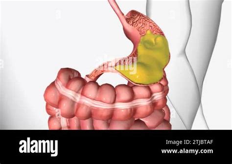 Gastric Outlet Obstruction Goo Is A Result Of Any Disease Process