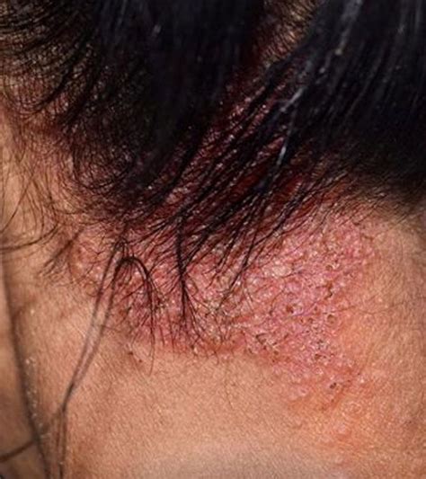 8 Home Remedies To Get Rid Of Scalp Fungus Prevention Tips Artofit