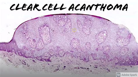 Clear Cell Acanthoma With Pas Stain 5 Minute Pathology Pearls Youtube