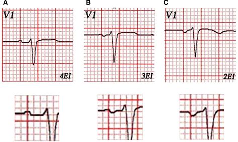 P Wave Parameters And Indices A Critical Appraisal Of Clinical Utility