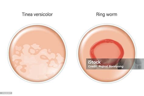 Comparison Of Tinea Versicolor And Ring Worm Dermatology