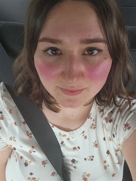 Does This Look Like A Malar Rash The Lupus Forum