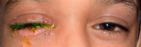 Preseptal And Orbital Cellulitis Clinical Tree