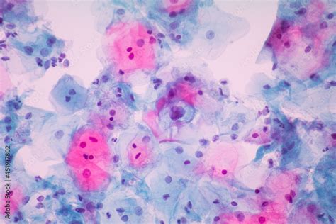 View In Microscopic Of Abnormal Human Cervix Cellssquamous Epithelium