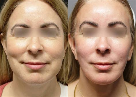 Orbital Fat Transfer In Washington Dc Sherber Rad