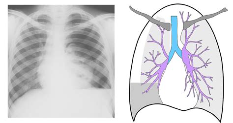 SchÃ©ma Dun Kyste Hydatique