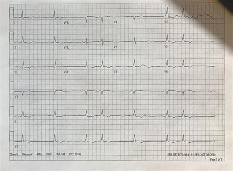 70yr Old Male With 1 Episode Of Syncope Kco Afib On Metoprolol And