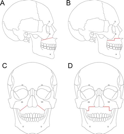 Maxillary Osteotomy Improving Jaw Alignment And Function