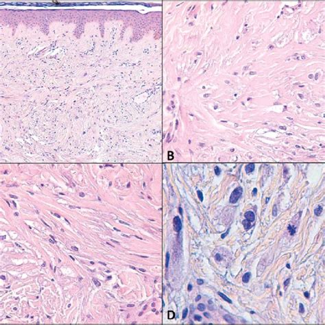 Scanning View Showing The Polypoid Lesion With The Associated Epidermal Download Scientific