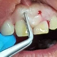 Gingival Pocket Exploration And Marking On Facial Surface Of 11 And 21