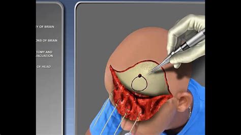 Presentation Group Interactive Craniotomy And Clot Evacuation With Ct