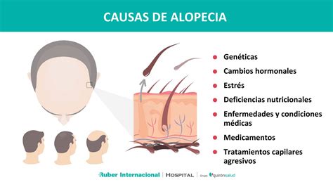 Alopecia Qué Es Cómo Se Diagnóstica Cuál Es Su Tratamiento