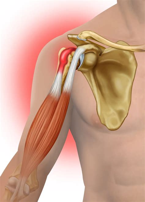 Fisioterapia Para Tendinitis Del Brazo Efisio Fisioterapia Madrid