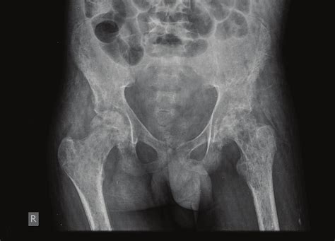 X Ray Of The Pelvis Showed Multiple Permeative Lesions Involving The