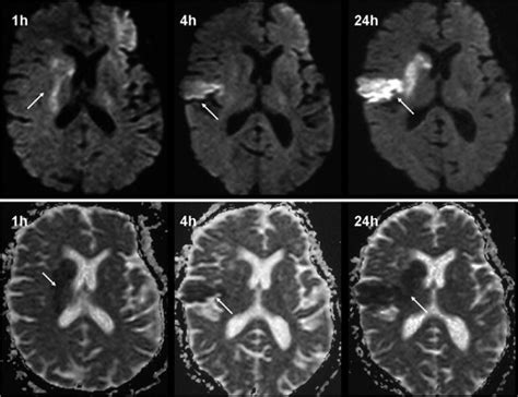 Lentiform Nucleus Stroke Imaging Of Acute Stroke And Transient Ischaemic Attack