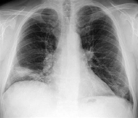 What Does Linear Opacity Mean At Becky Uhl Blog