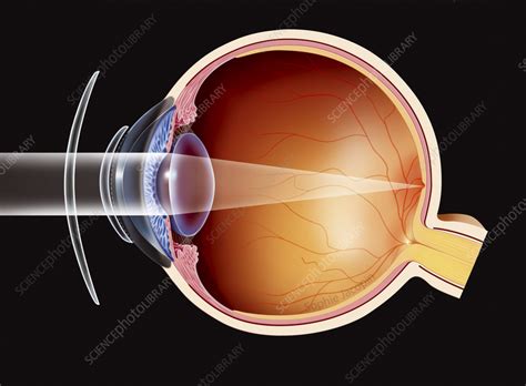 Refractive Surgery Treatments Illustration Stock Image C0602212