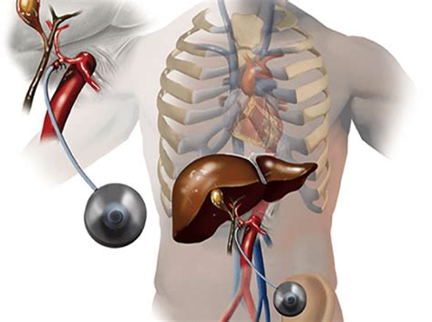 Hepatic Infusion Pumps For Crc Liver Metastases
