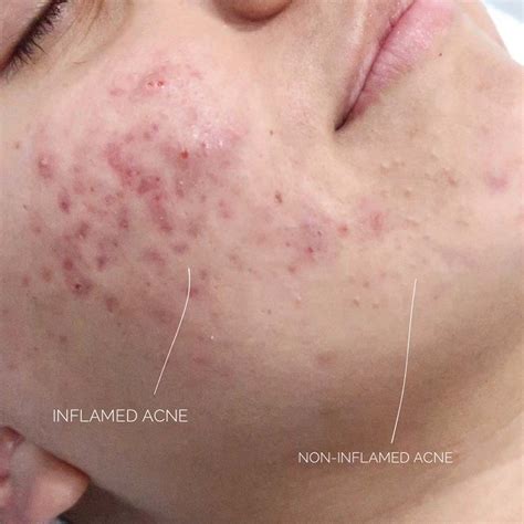 Microdermabrasion For Acne And Acne Scar Can It Help