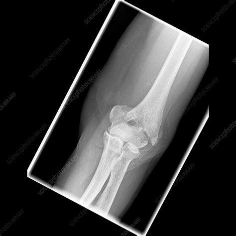 Right Elbow Fracture X Ray At Jeff Updike Blog