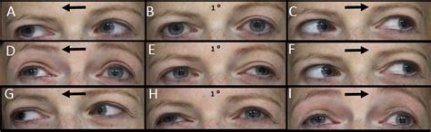 A Rare Case Of Bilateral Ocular Neuromyotonia Canadian Journal Of