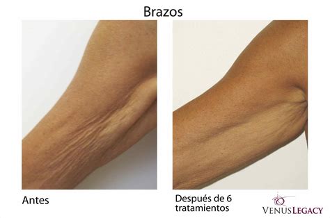 Venus Legacy Reafirmación Facial Y Corporal Dermatologia En Lima
