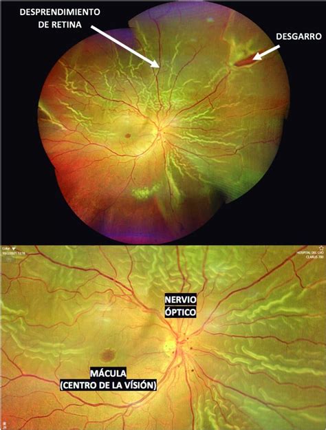 Desprendimiento De Retina Hospital Del Ojo