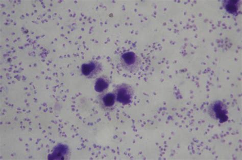 Thin And Thick Blood Smear For Malaria