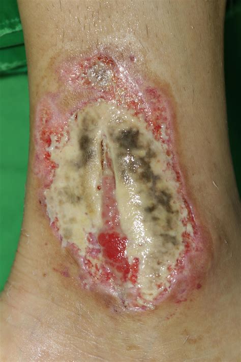 Misdiagnosis Of Pyoderma Gangrenosum Increases Medical Costs And Prolongs Hospital Stay A Case
