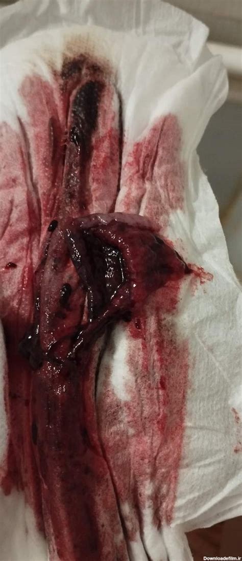 عکس جنین سقط شده پنج هفته ای نی نی سایت