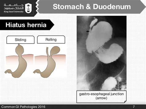 Common Gi Pathologies