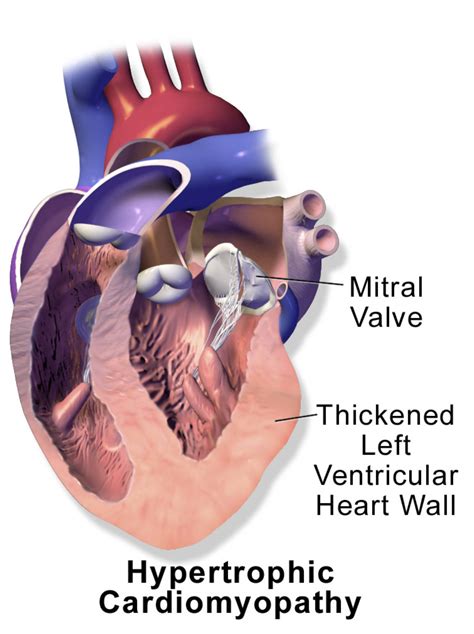 Hypertrophic Cardiomyopathy Understanding The Thickened Heart Muscle