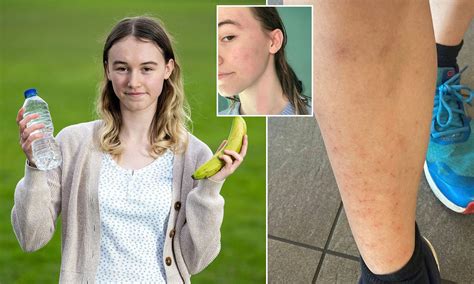 Teenager Suffers 40 Different Allergies Including Water