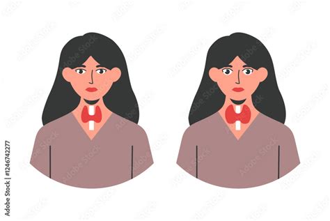 Graves Disease Illustration Showing A Woman With Bulging Eyes And