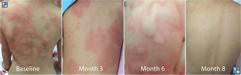 Urticaria Hives Tangs Clinical Tcm