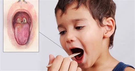 Tres Casos De Difteria Fueron Confirmados En Bolívar