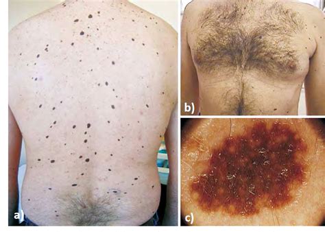 Figure 1 From Fast And Simultaneous Growth Of Multiple Melanocytic Nevi