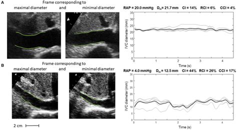 Inferior Vena Cava Ivc Dynamics In Patients With Different Right Download Scientific Diagram
