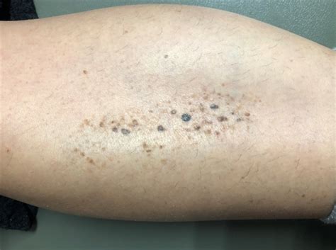 Nevo De Spilus Asociado A Nevo Azul Agminado En Mujer De 28 Años Revista Argentina De