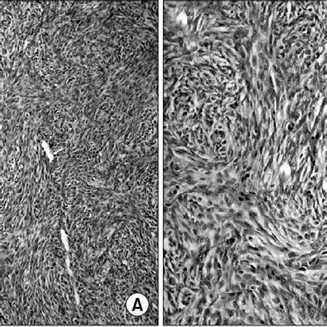 Cellular Fibroma Area Showing A Cellular Proliferation Of Intersecting Download Scientific