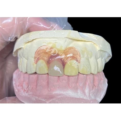 Nesbit Flexible Partial Denture For Incisors Offering A Seamless
