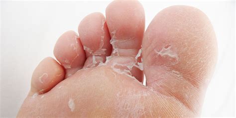 Toe Skin Peeling Skin Peeling Between The Toes What It Means