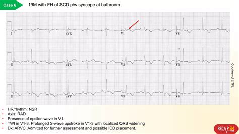 Ecg In Syncope Pptx