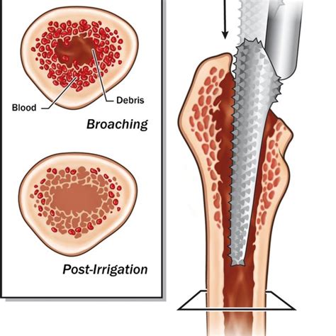 Dorr Classification Of Proximal Femur Download Scientific Diagram