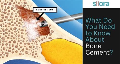 What Do You Need To Know About Bone Cement